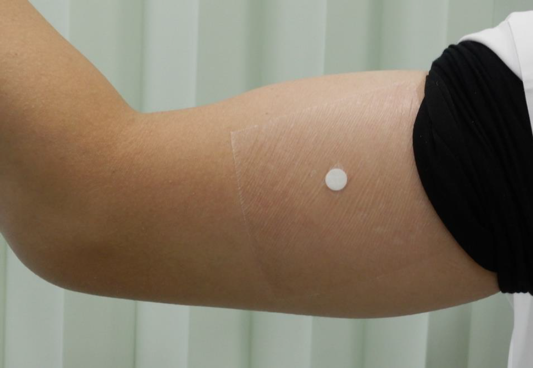 円形脱毛症に対する局所免疫療法（SADBE療法） - さくら皮膚科医院 東京都 - 江戸川区 - 船堀 - 船堀駅前- 皮膚科