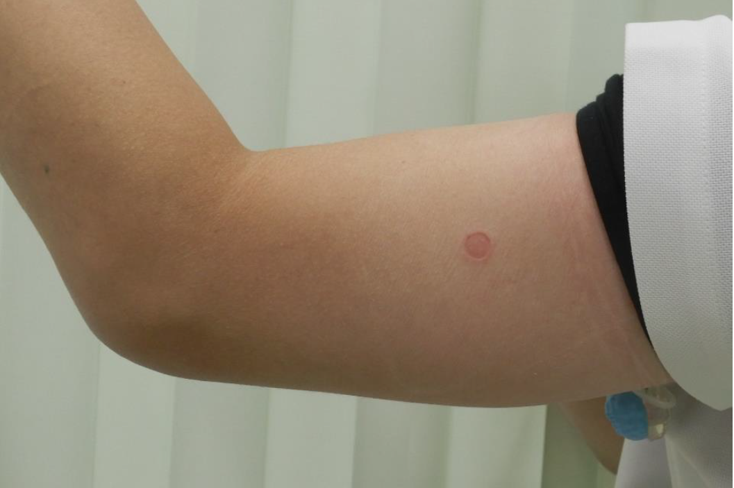 円形脱毛症に対する局所免疫療法（SADBE療法） - さくら皮膚科医院 東京都 - 江戸川区 - 船堀 - 船堀駅前- 皮膚科