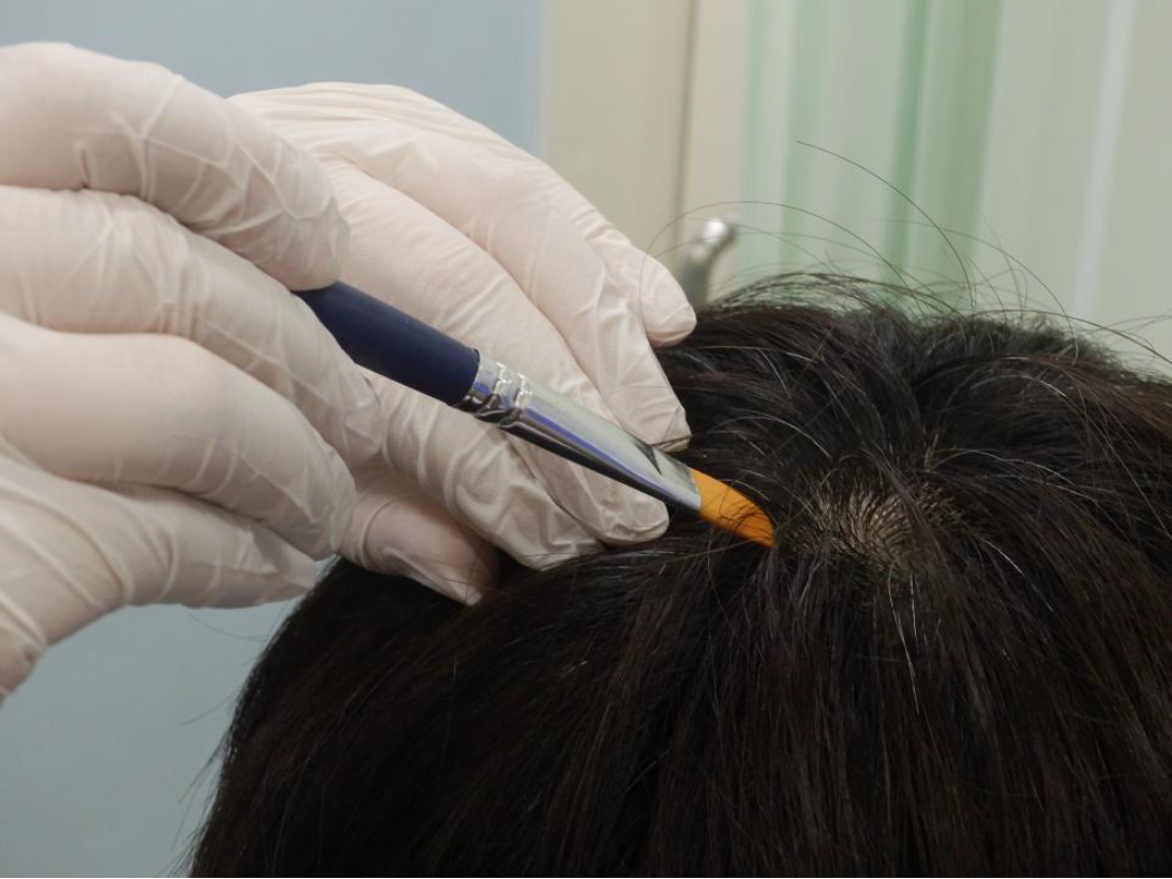 円形脱毛症に対する局所免疫療法（SADBE療法） - さくら皮膚科医院 東京都 - 江戸川区 - 船堀 - 船堀駅前- 皮膚科